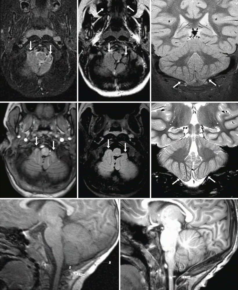 Cerebellar Tonsillar Ectopia | SpringerLink