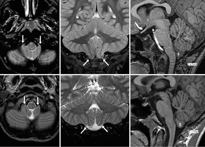 Cerebellar Tonsillar Ectopia | SpringerLink
