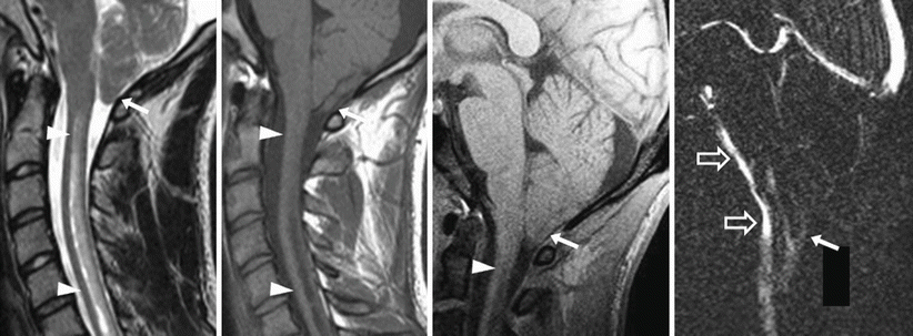 Cerebellar Tonsillar Ectopia | SpringerLink