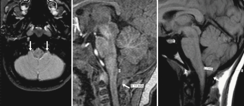 Cerebellar Tonsillar Ectopia | SpringerLink