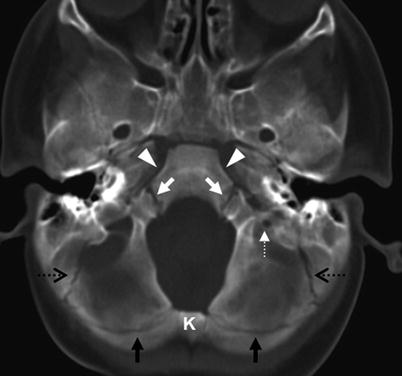 Pediatric Skull: Normal Pediatric Sutures on Computed Tomography ...