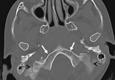 Pediatric Skull: Normal Pediatric Sutures on Computed Tomography ...