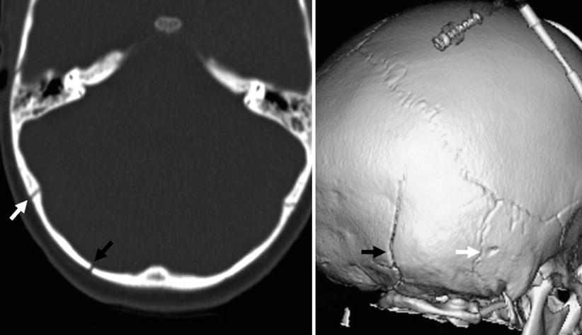Pediatric Skull: Normal Pediatric Sutures on Computed Tomography ...