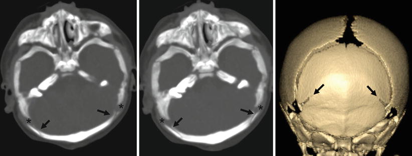 Pediatric Skull: Normal Pediatric Sutures on Computed Tomography ...
