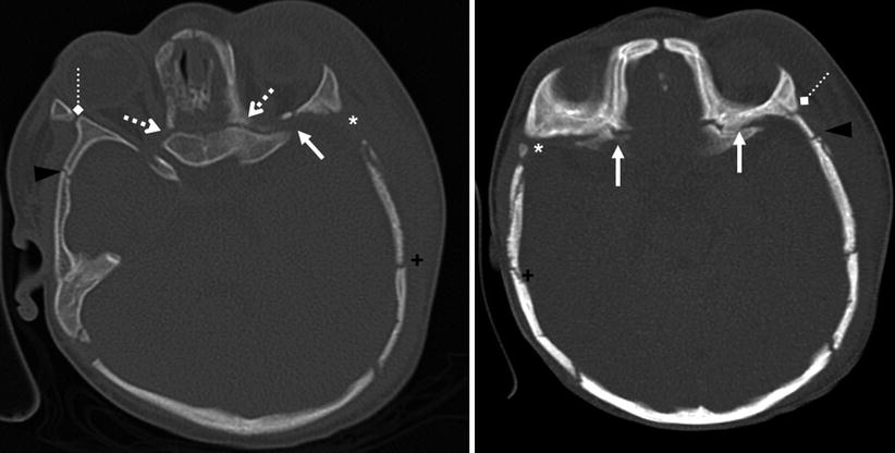 Pediatric Skull: Normal Pediatric Sutures on Computed Tomography ...