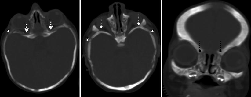 Pediatric Skull: Normal Pediatric Sutures on Computed Tomography ...