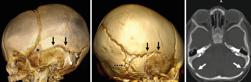 Pediatric Skull: Normal Pediatric Sutures on Computed Tomography ...