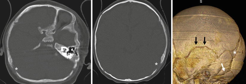 Pediatric Skull: Normal Pediatric Sutures on Computed Tomography ...