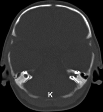 Pediatric Skull: Normal Pediatric Sutures on Computed Tomography ...