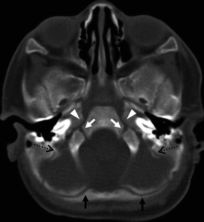 Pediatric Skull: Normal Pediatric Sutures on Computed Tomography ...