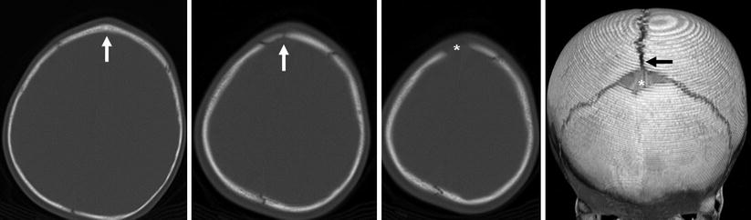 Normal Variations and Developmental Anatomy of the Calvarial Sutures ...