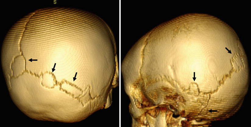 Normal Variations and Developmental Anatomy of the Calvarial Sutures ...