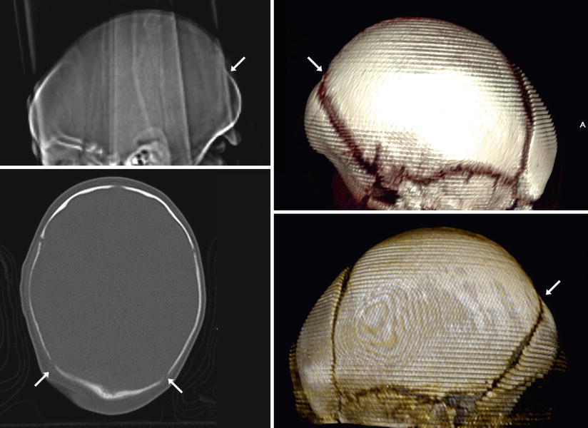 Normal Variations and Developmental Anatomy of the Calvarial Sutures ...