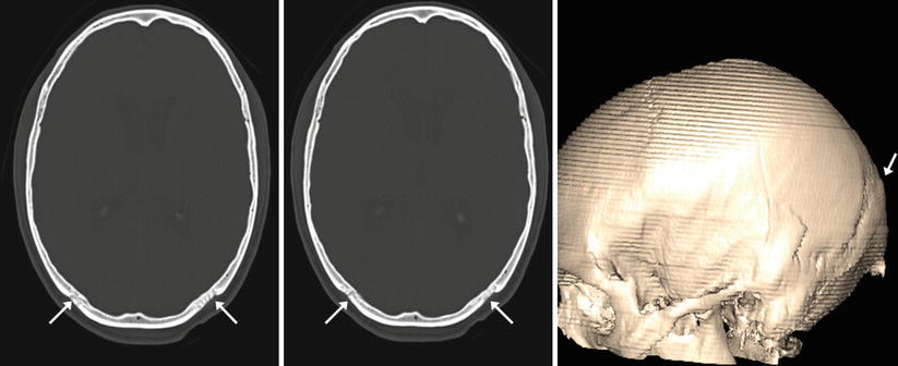 Normal Variations and Developmental Anatomy of the Calvarial Sutures ...