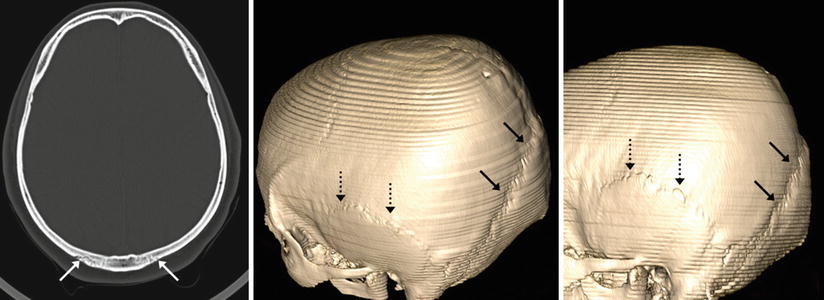 Normal Variations and Developmental Anatomy of the Calvarial Sutures ...