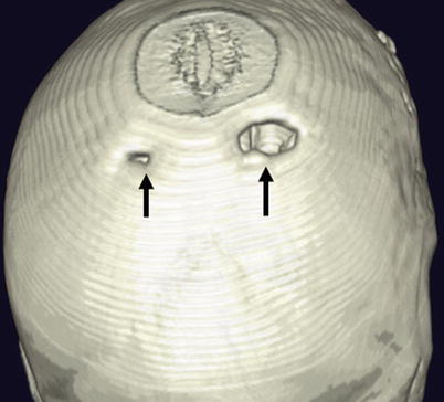 Emissary Veins, Vascular-Containing Foramina, and Vascular Depressions ...