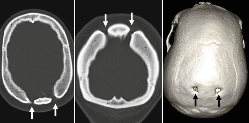 Emissary Veins, Vascular-Containing Foramina, and Vascular Depressions ...