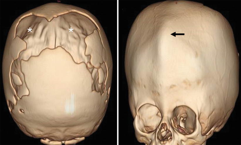 Emissary Veins, Vascular-Containing Foramina, and Vascular Depressions ...