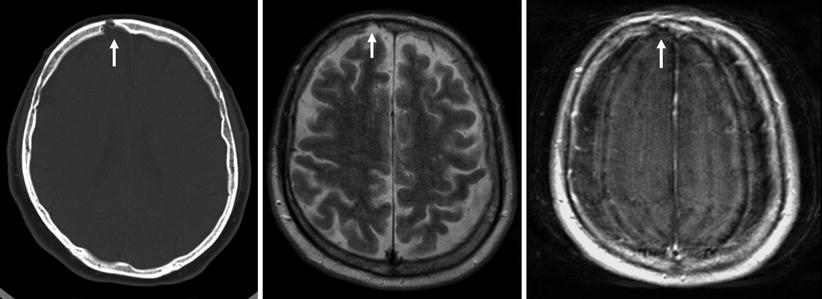 Other “Don’t Touch” Skull Lesions: Arachnoid Granulations, Calvarial ...