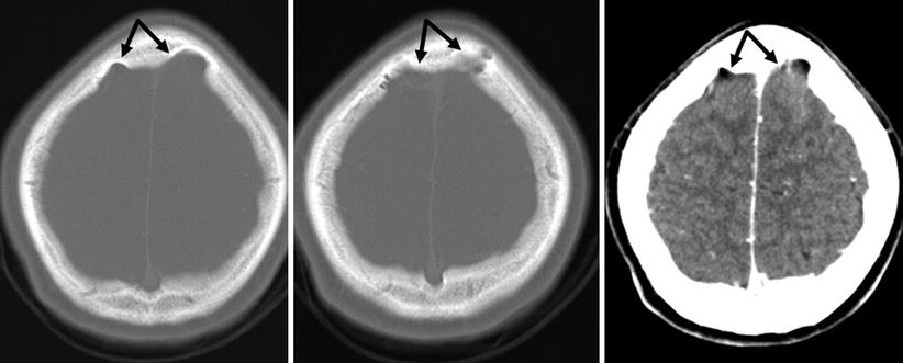 Other “Don’t Touch” Skull Lesions: Arachnoid Granulations, Calvarial ...