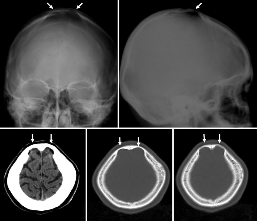 Other “Don’t Touch” Skull Lesions: Arachnoid Granulations, Calvarial ...
