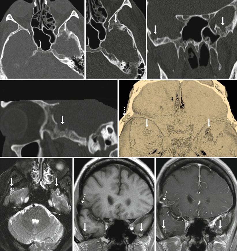 Other “Don’t Touch” Skull Lesions: Arachnoid Granulations, Calvarial ...