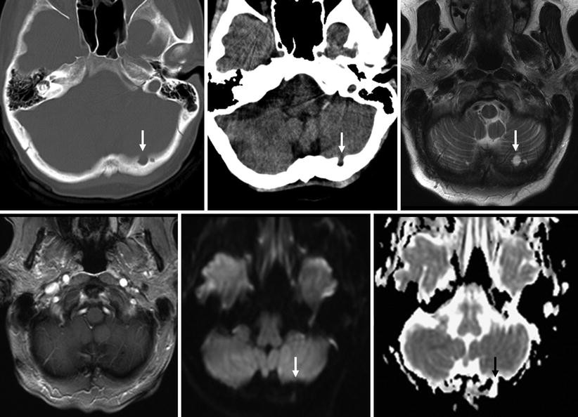 Other “Don’t Touch” Skull Lesions: Arachnoid Granulations, Calvarial ...