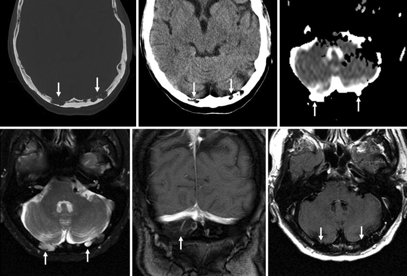 Other “Don’t Touch” Skull Lesions: Arachnoid Granulations, Calvarial ...