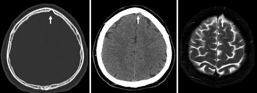 Other “Don’t Touch” Skull Lesions: Arachnoid Granulations, Calvarial ...
