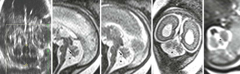 Mega Cisterna Magna and Retrocerebellar Arachnoid Cysts | SpringerLink