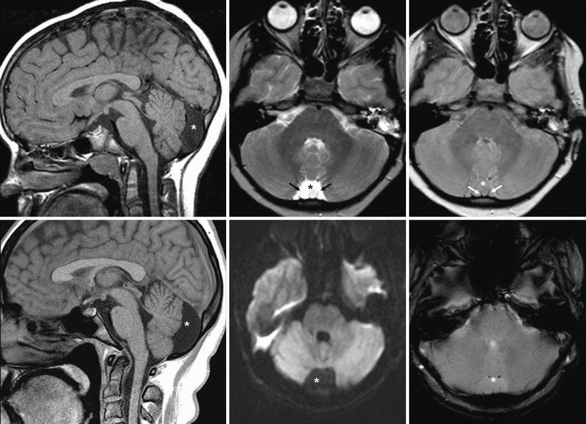 Mega Cisterna Magna and Retrocerebellar Arachnoid Cysts | SpringerLink