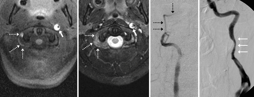 Artifacts of the Craniocervical Arterial System on MRI | SpringerLink