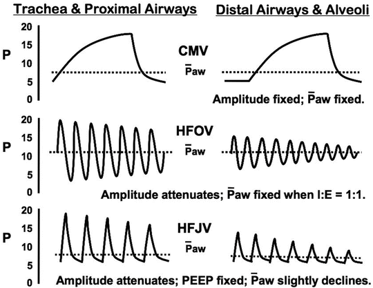 High-Frequency Ventilation: General Concepts | SpringerLink