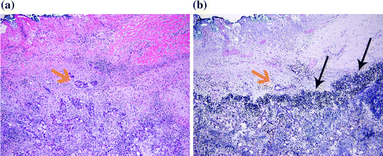 Lung Cancer Staging and Prognosis | SpringerLink
