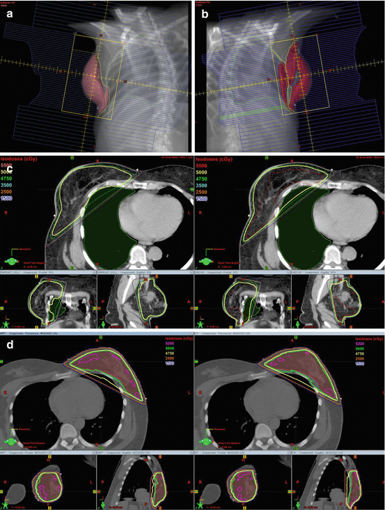 Intensity-Modulated Radiation Therapy for Breast Cancer | SpringerLink