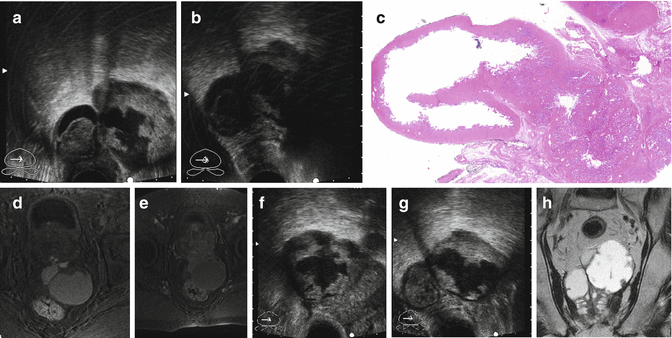 Prostatic Cysts | SpringerLink