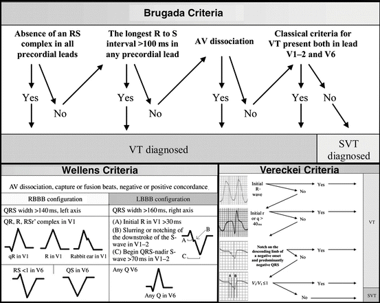 Ventricular Tachycardia | SpringerLink