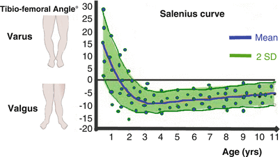 What Is the Best Treatment for Blount’s Disease? | SpringerLink