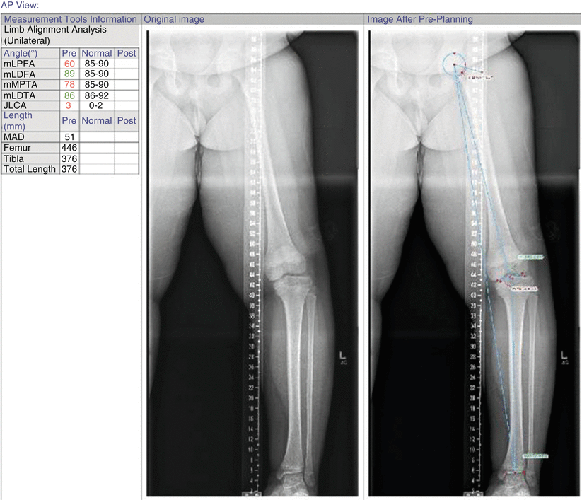 What Is the Best Treatment for Blount’s Disease? | SpringerLink