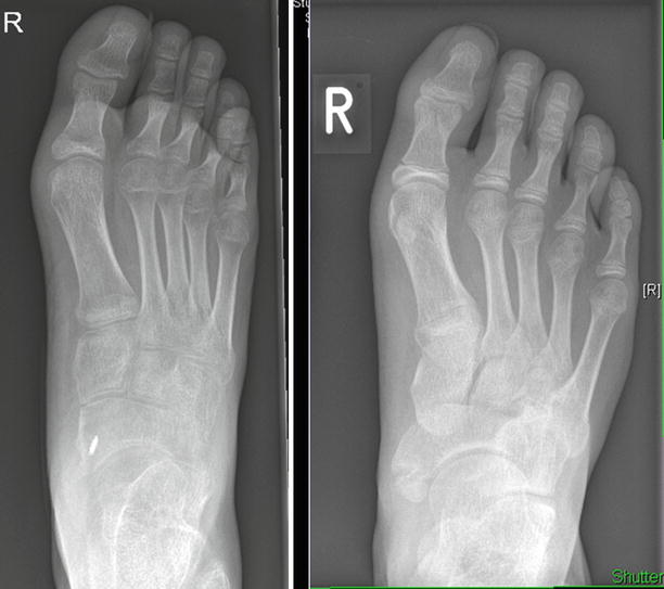Evidence-Based Treatment of Accessory Navicular Bone | SpringerLink