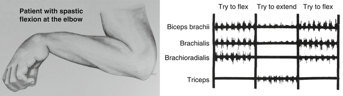Neurologic Injury and Spasticity | SpringerLink