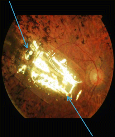 Argus® II Retinal Prosthesis System | SpringerLink