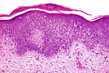 Spongiotic Dermatitis | SpringerLink