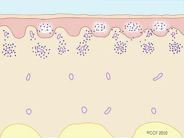 Spongiotic Dermatitis | SpringerLink