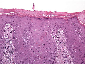 Spongiotic Dermatitis | SpringerLink