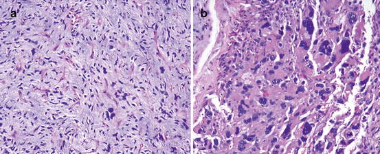 Undifferentiated Pleomorphic Sarcoma (UPS) (Malignant Fibrous ...