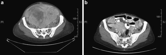 Undifferentiated Pleomorphic Sarcoma (UPS) (Malignant Fibrous ...