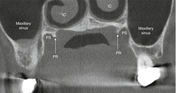 Hard and Soft Palate | SpringerLink