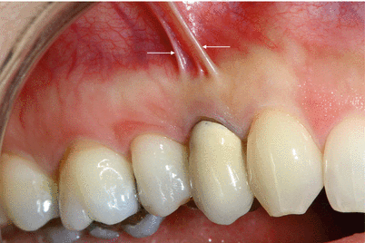 Vestibule and Cheeks | SpringerLink