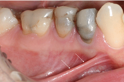 Vestibule and Cheeks | SpringerLink